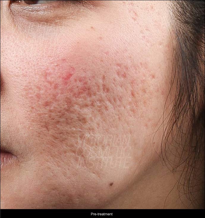 Skin Needling for Acne Scarring Melbourne - The Victorian Cosmetic...