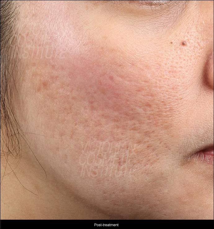 Skin Needling for Acne Scarring Melbourne - The Victorian Cosmetic...