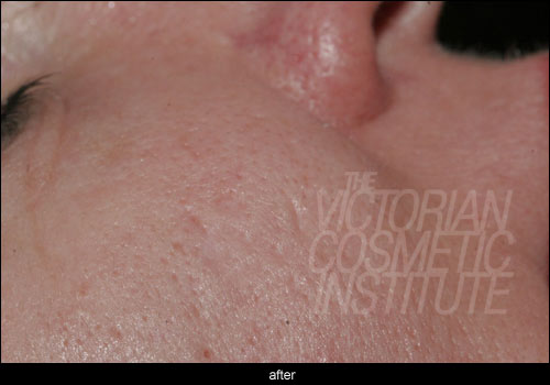 Skin Needling for Acne Scarring Melbourne - The Victorian Cosmetic...