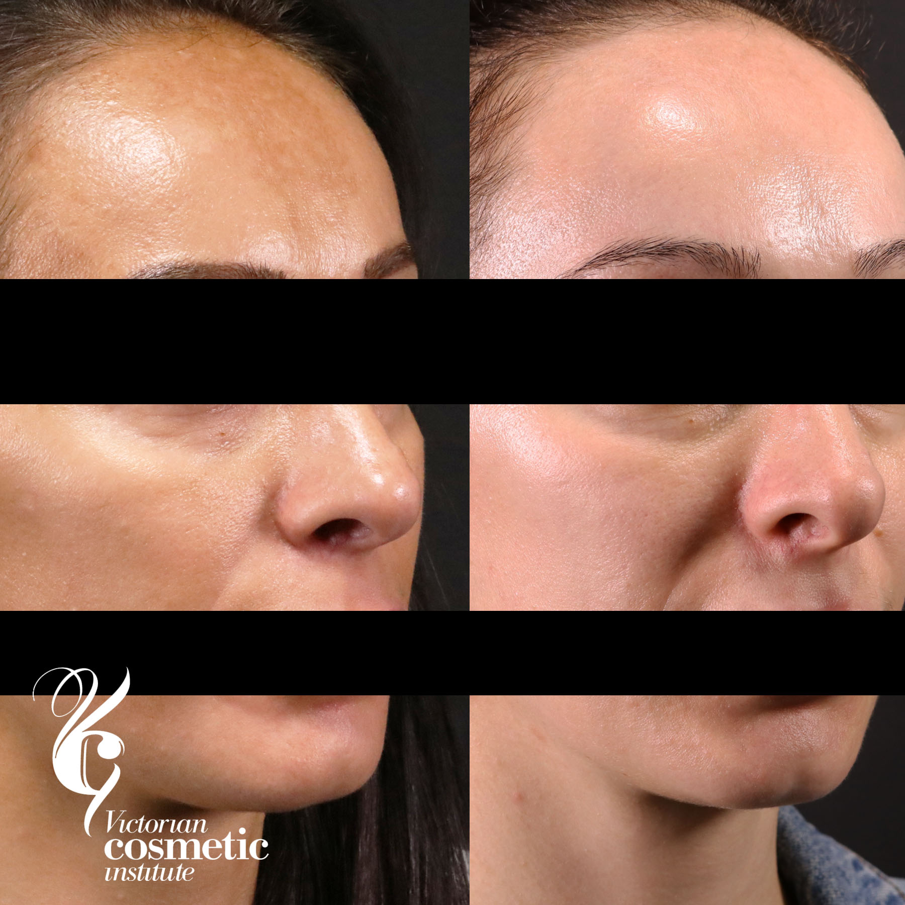 Melasma Treatment Melbourne | Victorian Cosmetic Institute