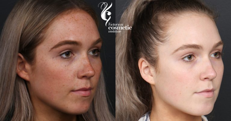 Freckle Removal Clinic | Victorian Cosmetic Institute