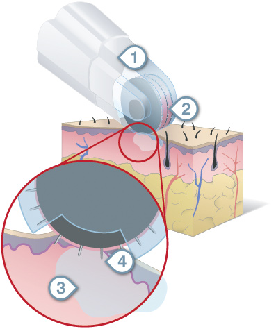 DermaFrac Melbourne - Victorian Cosmetic Institute