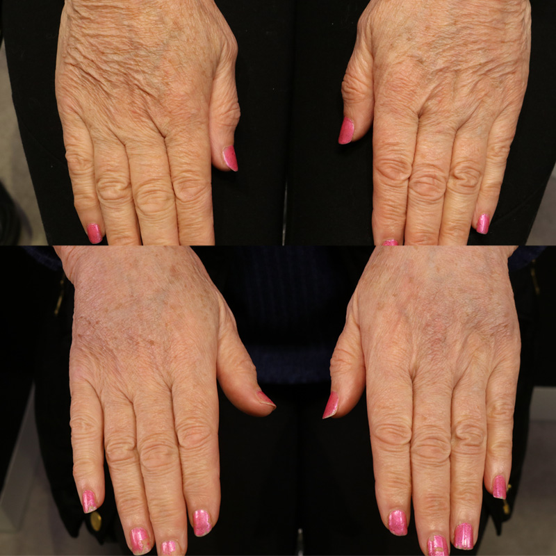 Revolumising Hands Treatment | Victorian Cosmetic Institute