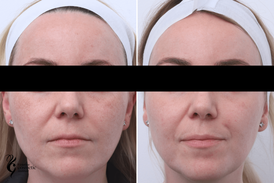 Melasma Treatment Melbourne | Victorian Cosmetic Institute