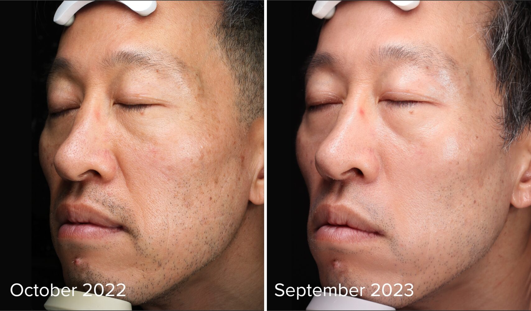 VISIA Skin Analysis | Victorian Cosmetic Institute